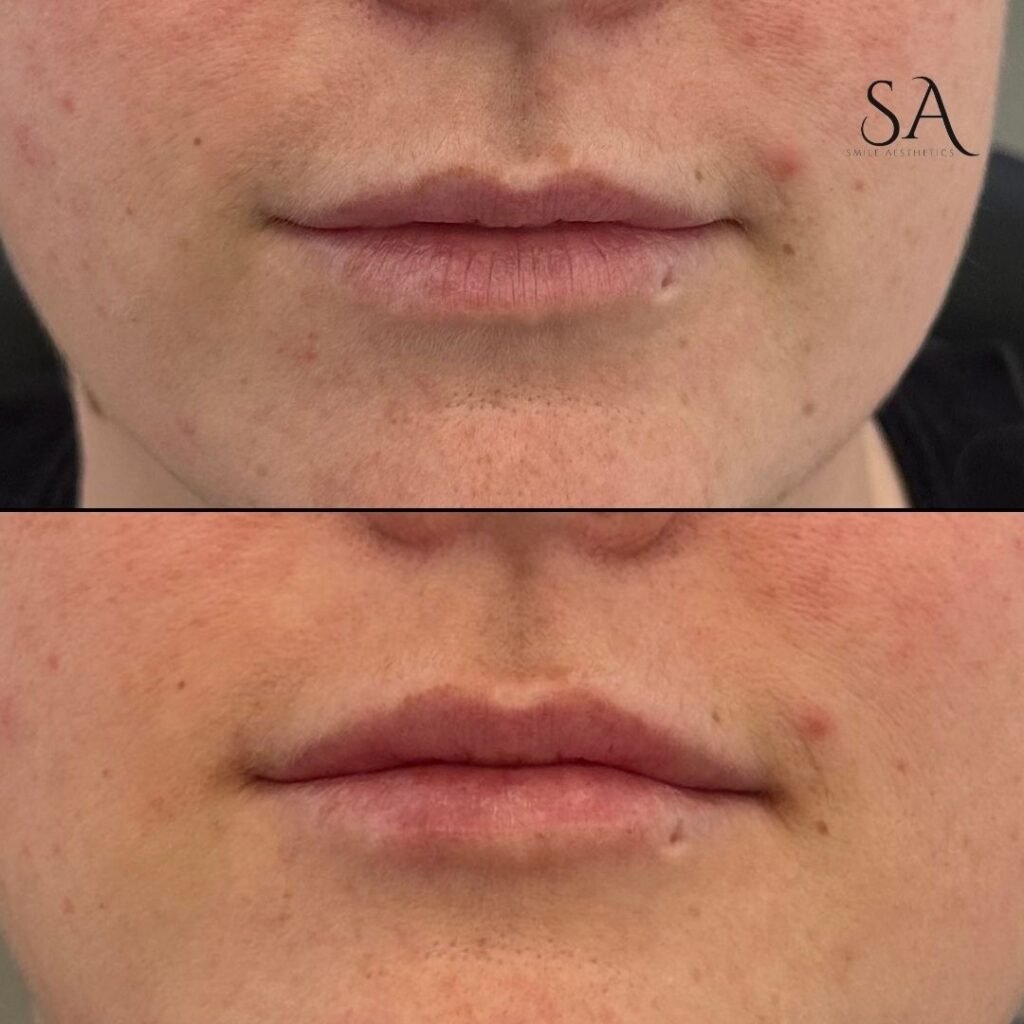 Lip Fillers Cardiff | Smile Aesthetics By Jamie | 5* Reviews